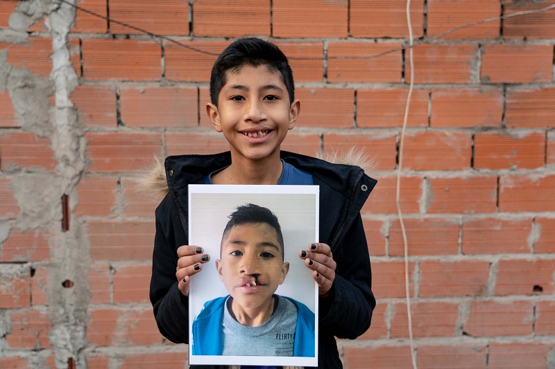 Día Mundial de la Sonrisa: la ONG Smile Train brinda tratamientos ...